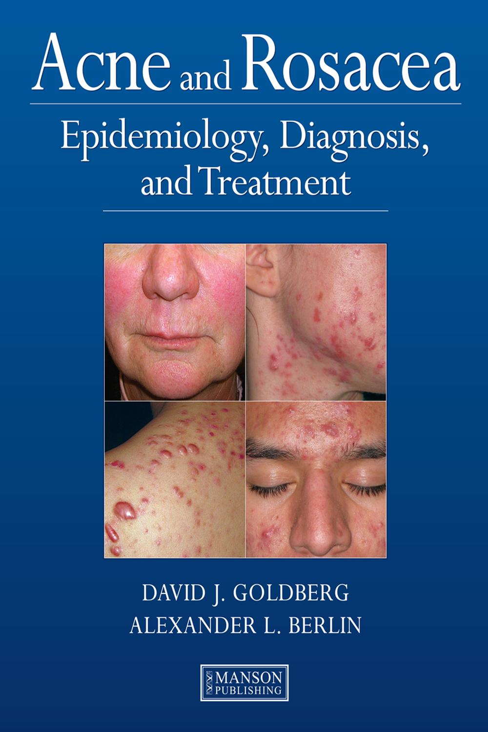 Rosacea Conglobata Acne Fulminans